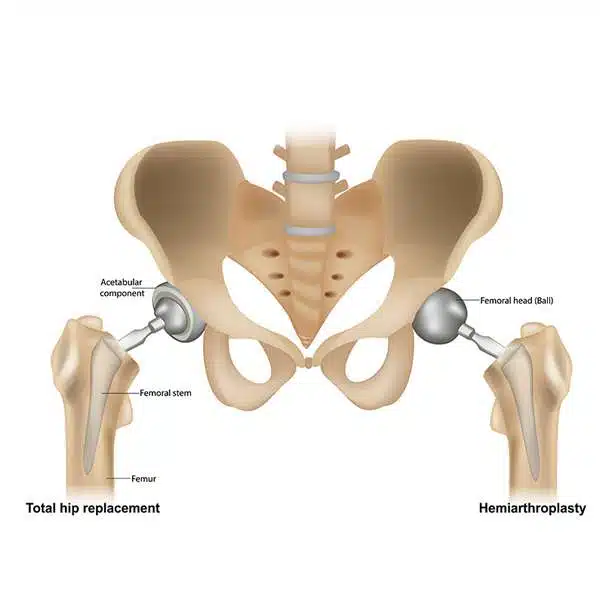 best hip replacement surgeon in Ahmedabad