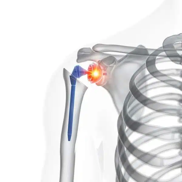 best orthopedic surgeon for shoulder replacement in Ahmedabad